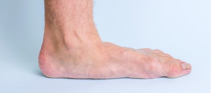 What is Acquired flat foot? - Sheffield Aches and Pains - Patients
